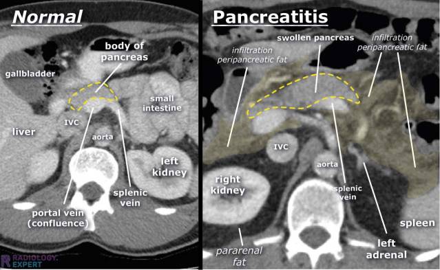Ct Abdomen General